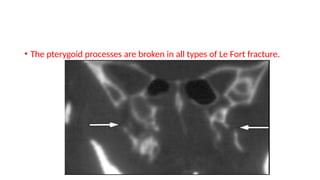 CLASSIFICATION OF LE FORT FRACTURE FDGHJHHC | PPT