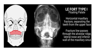 CLASSIFICATION OF LE FORT FRACTURE FDGHJHHC | PPT