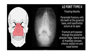 CLASSIFICATION OF LE FORT FRACTURE FDGHJHHC | PPT
