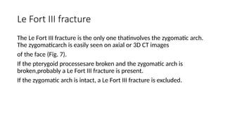 CLASSIFICATION OF LE FORT FRACTURE FDGHJHHC | PPT