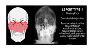 CLASSIFICATION OF LE FORT FRACTURE FDGHJHHC | PPT