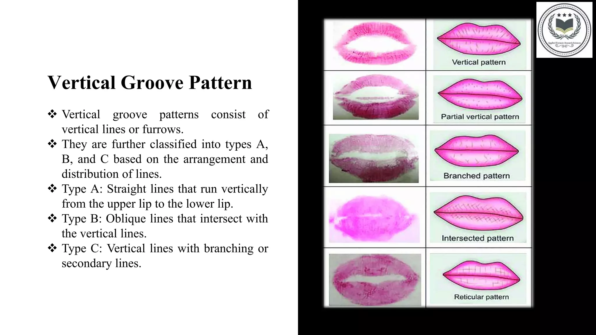 classification of lip prints | PPTX