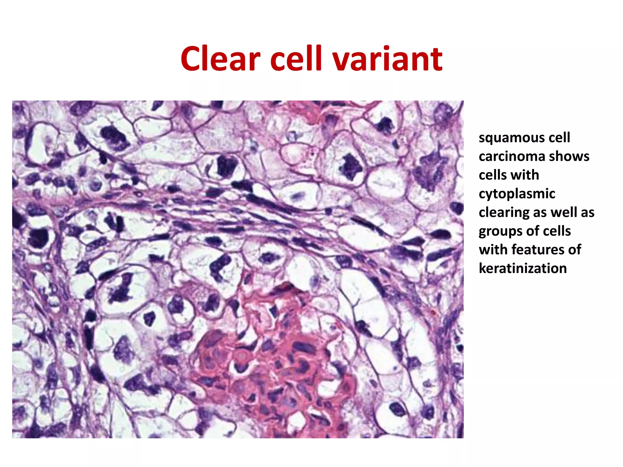 Classification Of Lung Tumors Ppt