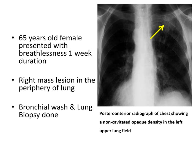 Classification Of Lung Tumors Ppt