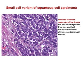 Small Cell Lung Cancer Histology