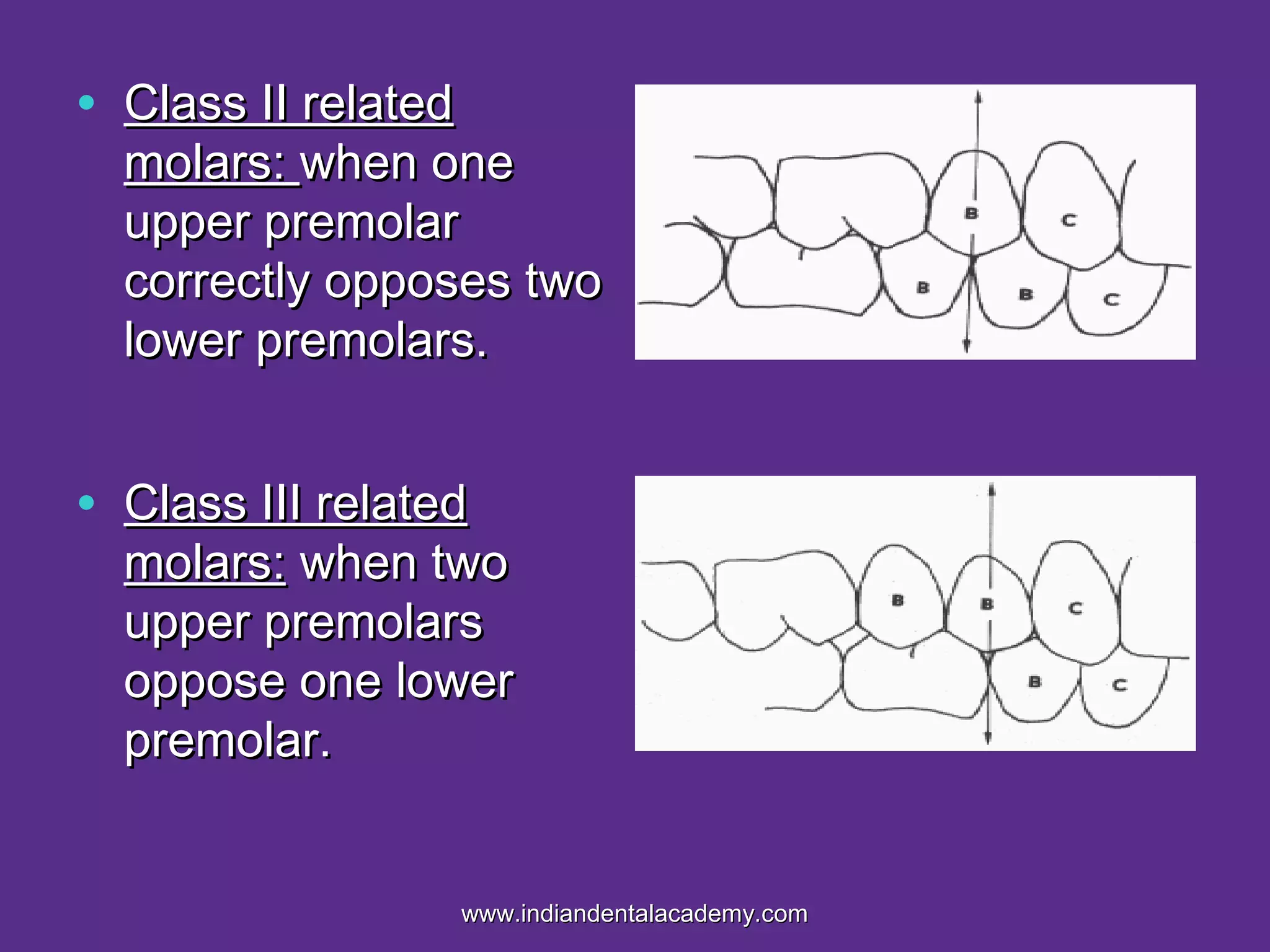 Classification of malocclusion | PPT