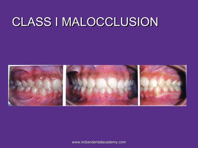 Classification of malocclusion | PPT