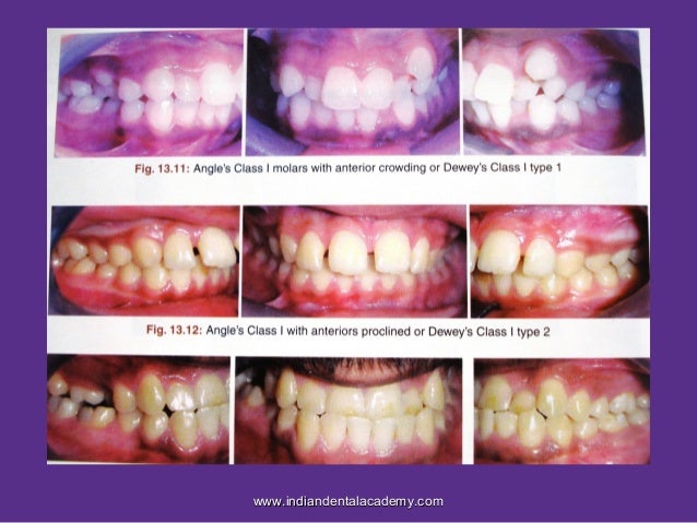 Classification of malocclusion