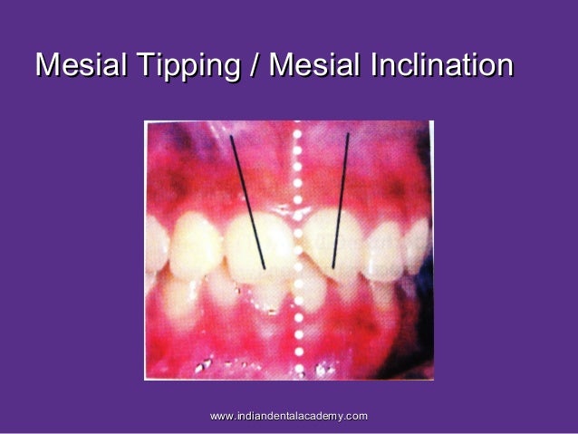 Classification of malocclusion