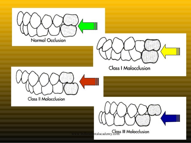 Classification of malocclusion /certified fixed orthodontic courses b…