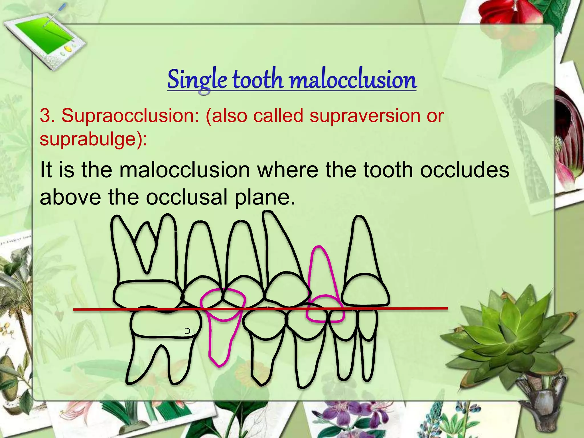 Classification of malocclsion | PPT