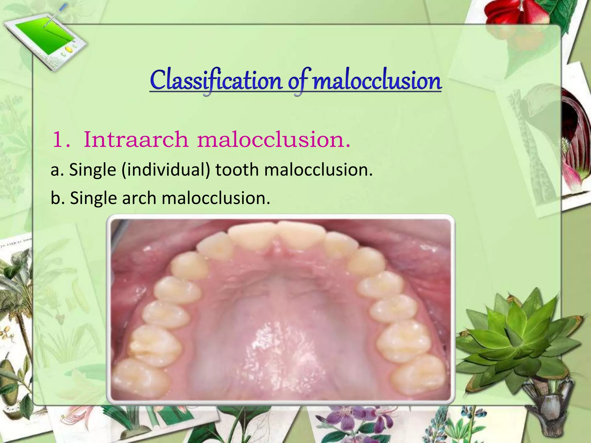 Classification of malocclsion | PPT