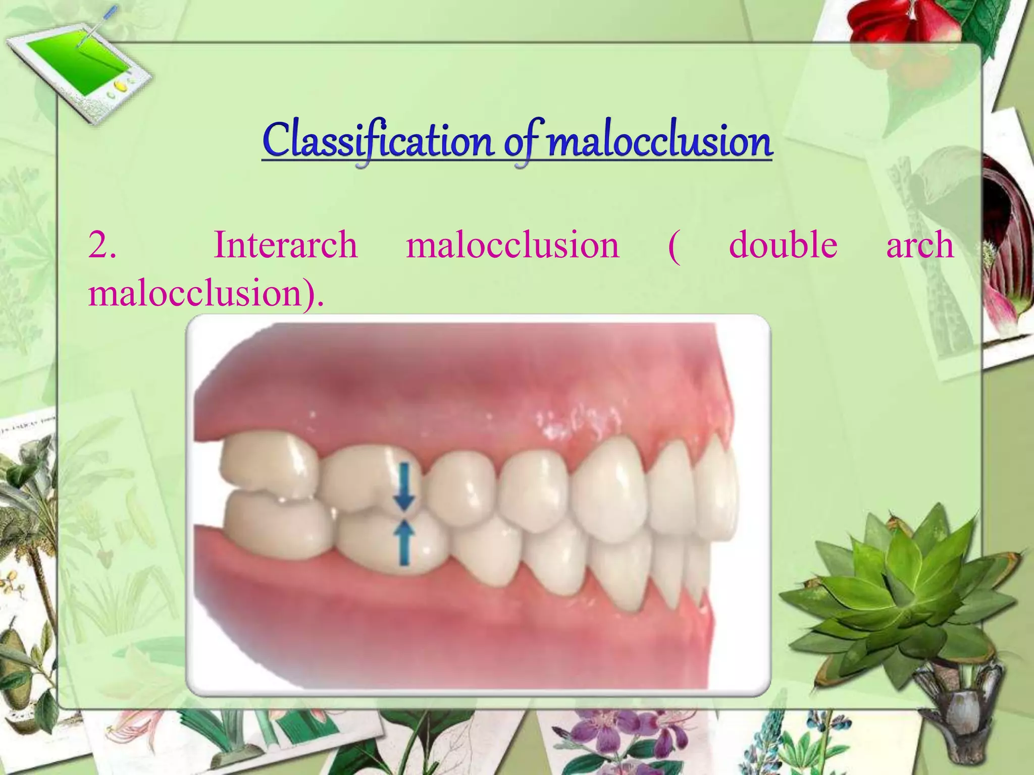 Classification of malocclsion | PPT