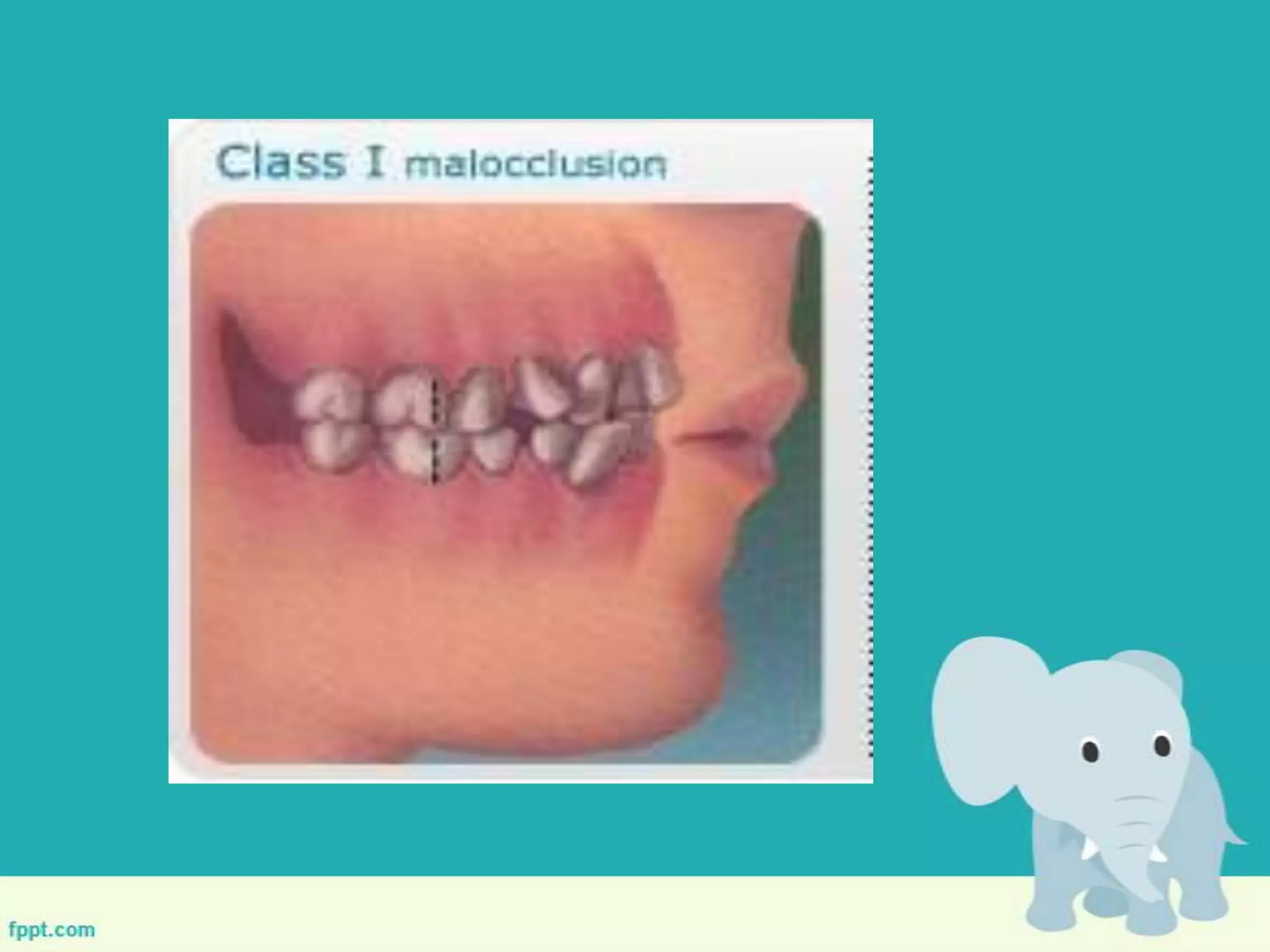 Classification of malocclusion in orthodontics | PPTX | Dental Health ...