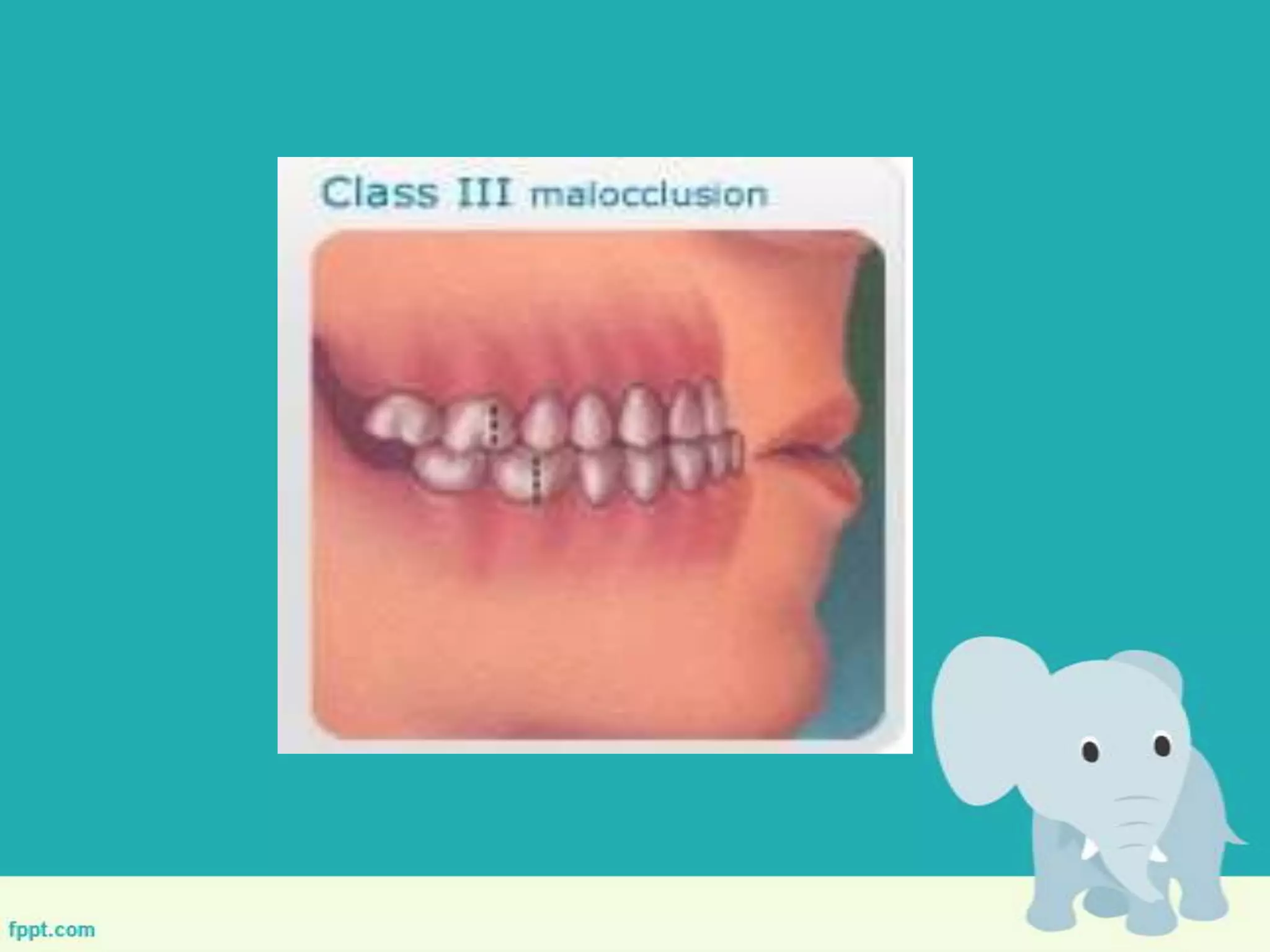 Classification of malocclusion in orthodontics | PPTX