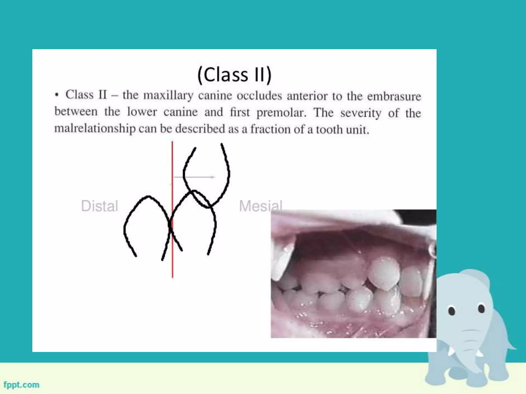 Classification of malocclusion in orthodontics | PPTX