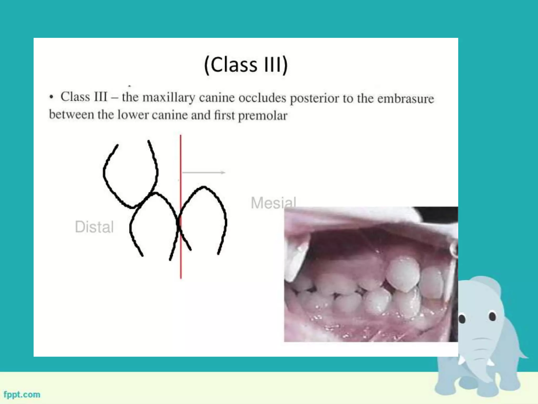 Classification of malocclusion in orthodontics | PPTX