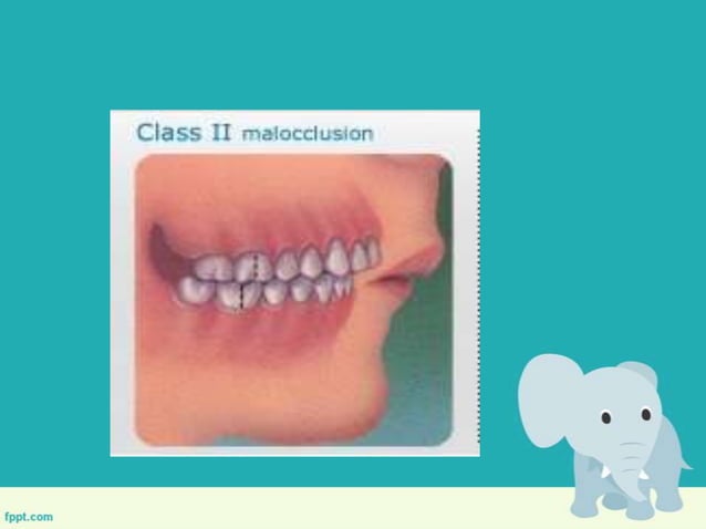 Classification of malocclusion in orthodontics