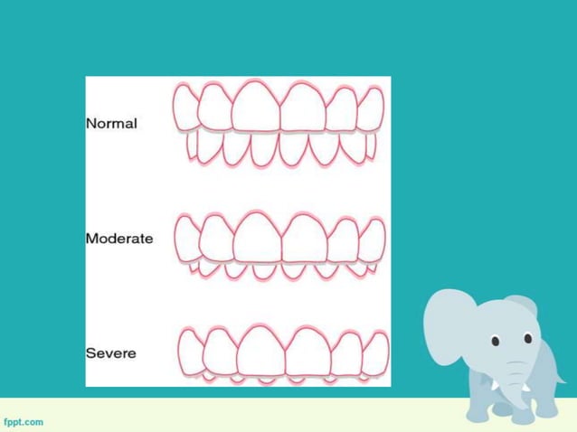 Classification of malocclusion in orthodontics
