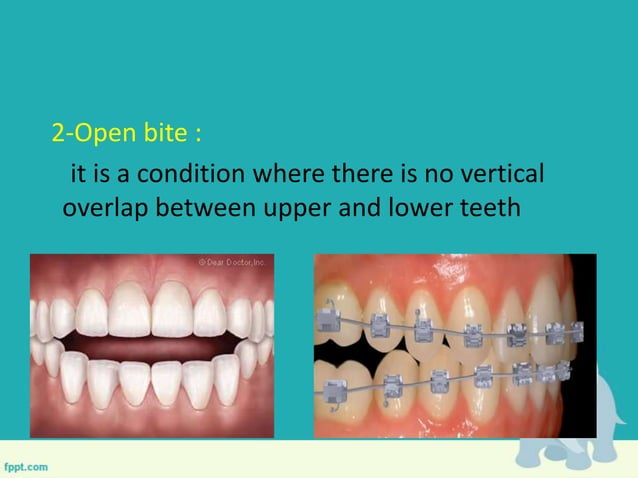 Classification of malocclusion in orthodontics