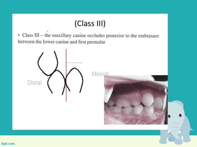 Classification of malocclusion in orthodontics