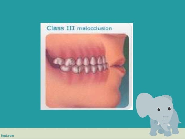 Classification of malocclusion in orthodontics