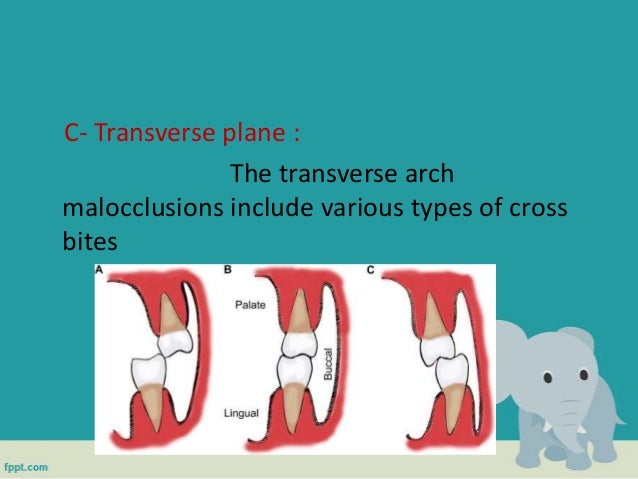 Classification of malocclusion in orthodontics