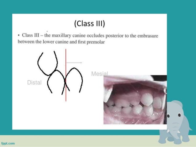 Classification of malocclusion in orthodontics