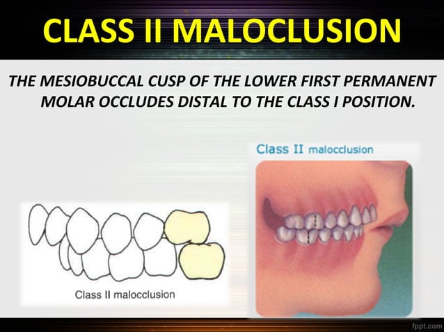 Classification of malocclusion | PPT | Dental Health | Diseases and ...