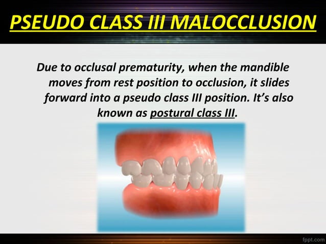 Classification of malocclusion | PPT | Dental Health | Diseases and ...