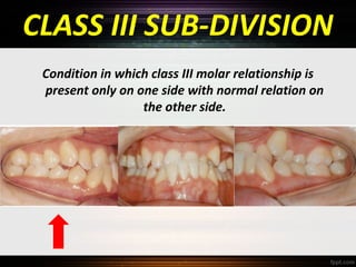Classification of malocclusion | PPT