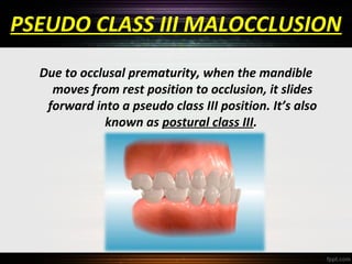 Classification of malocclusion | PPT