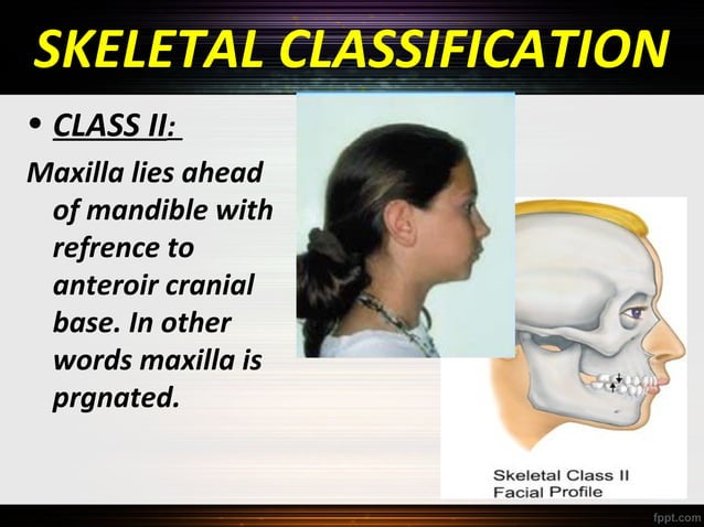 Classification of malocclusion