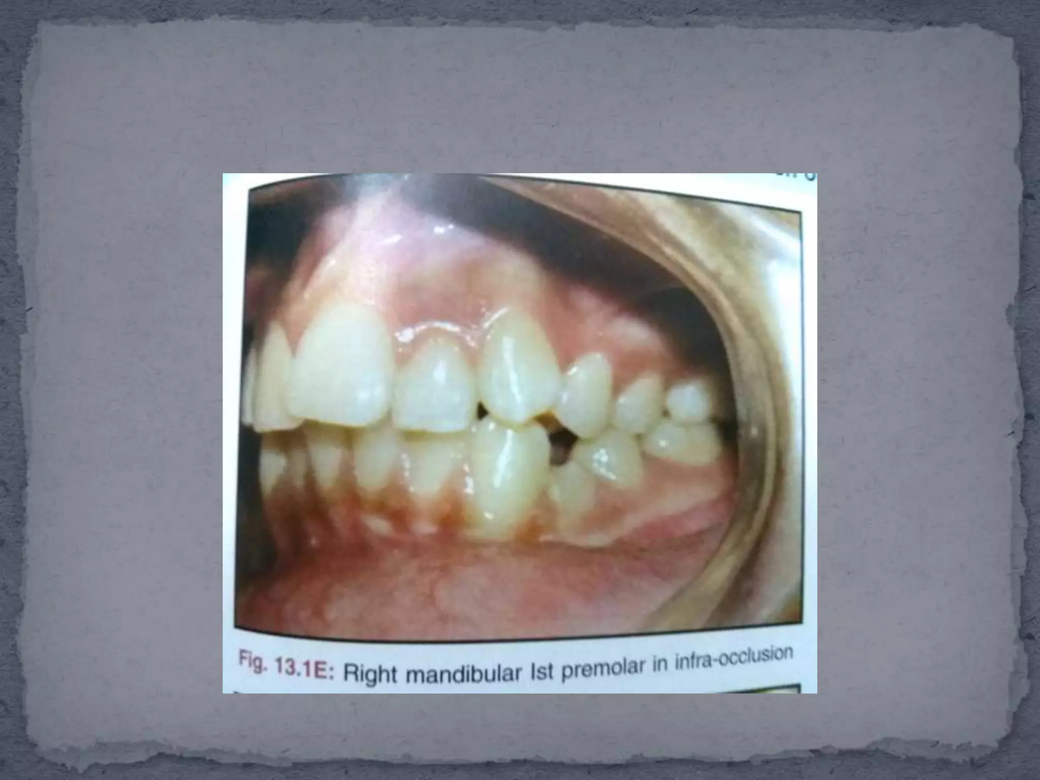 Classification Of Malocclusion | PPTX | Dental Health | Diseases and ...