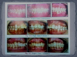 Classification Of Malocclusion | PPTX