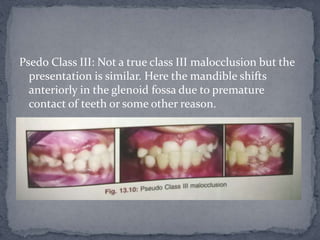Classification Of Malocclusion | PPTX