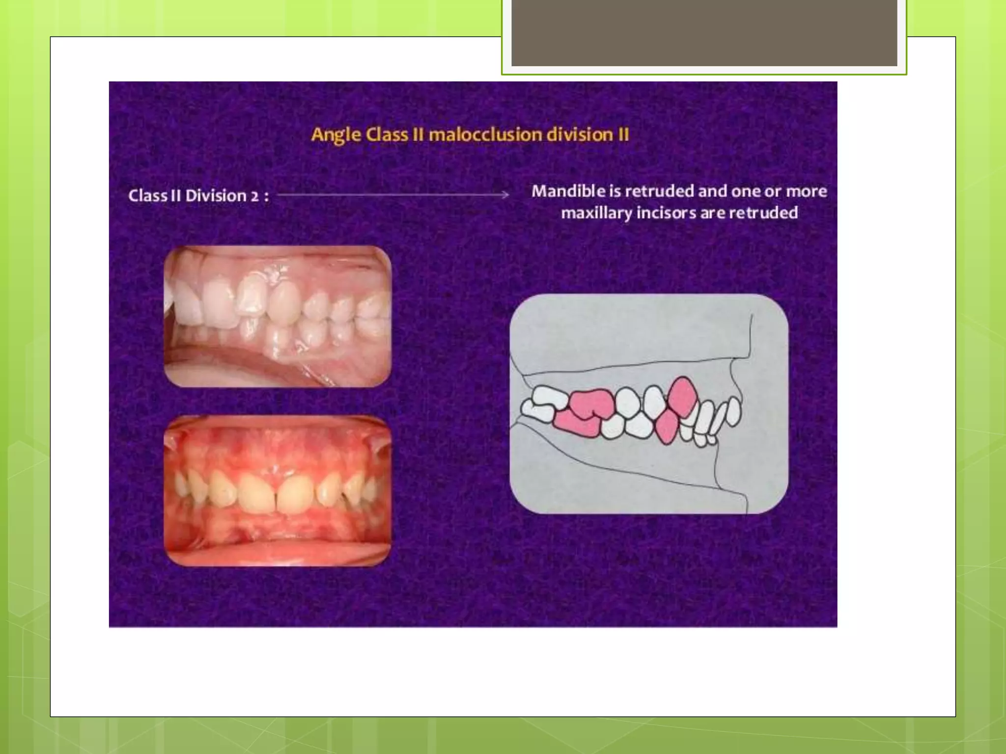 Classification of malocclusion | PPTX