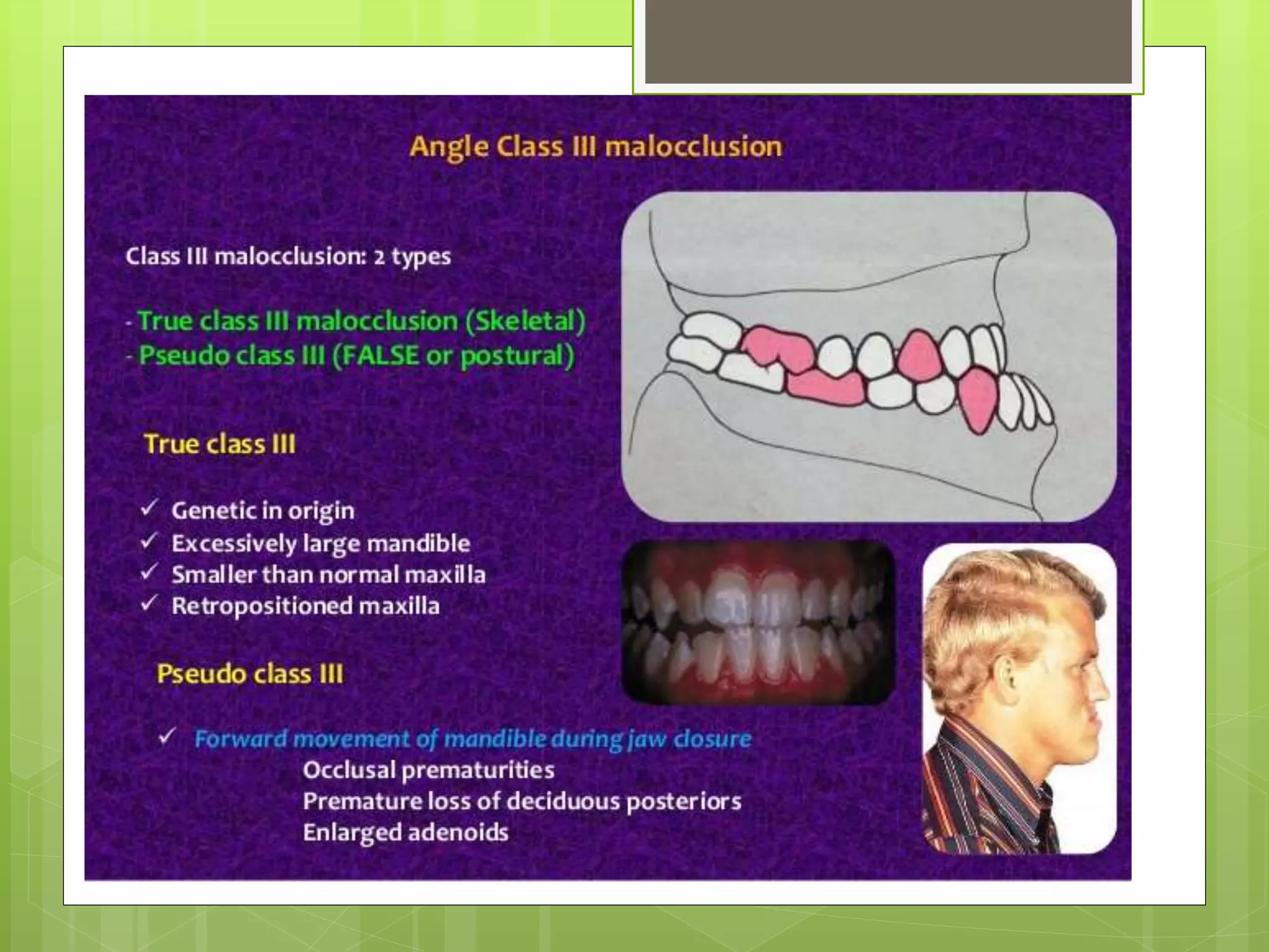 Classification of malocclusion | PPTX