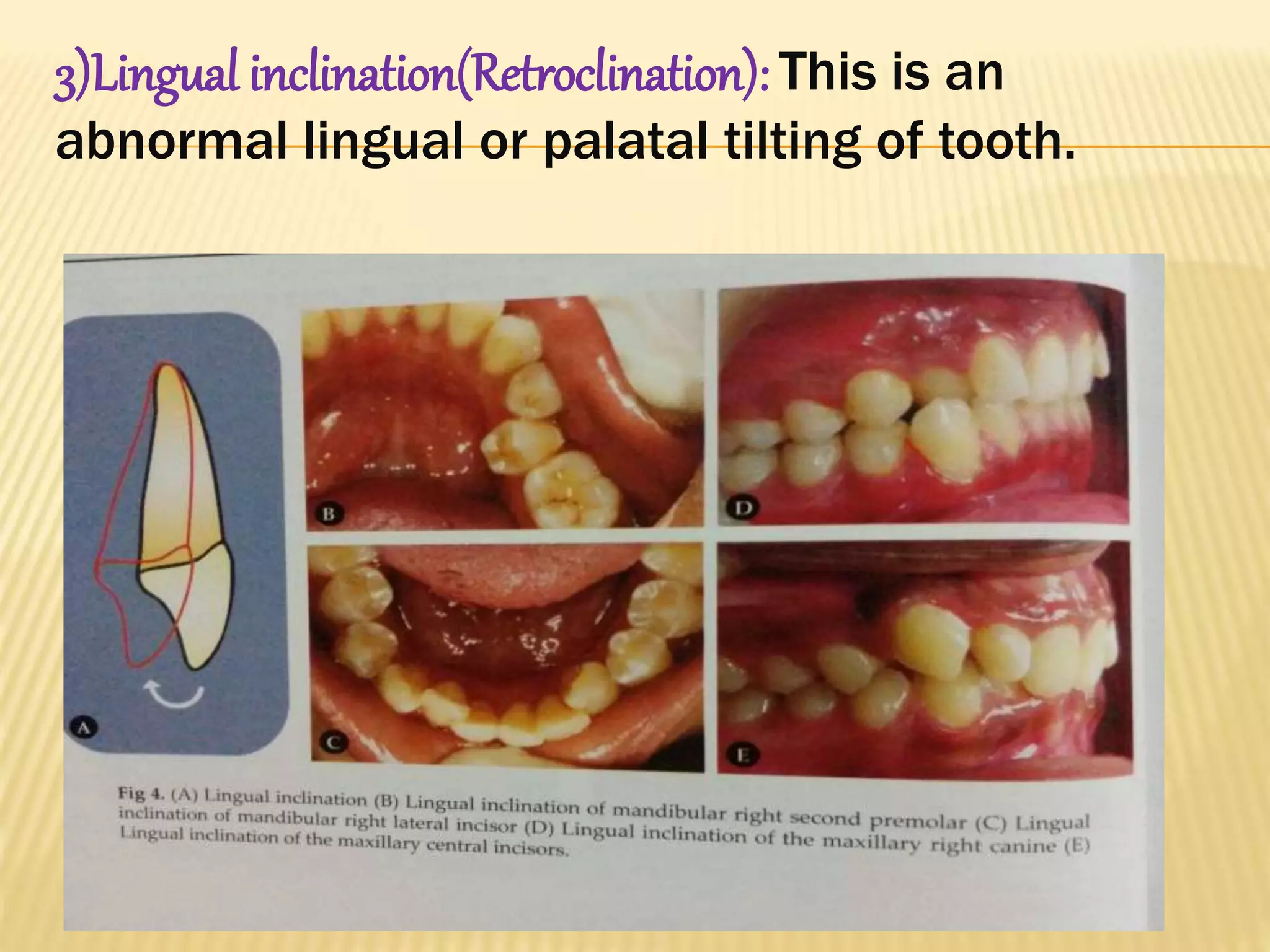 Classification of malocclusion | PPTX