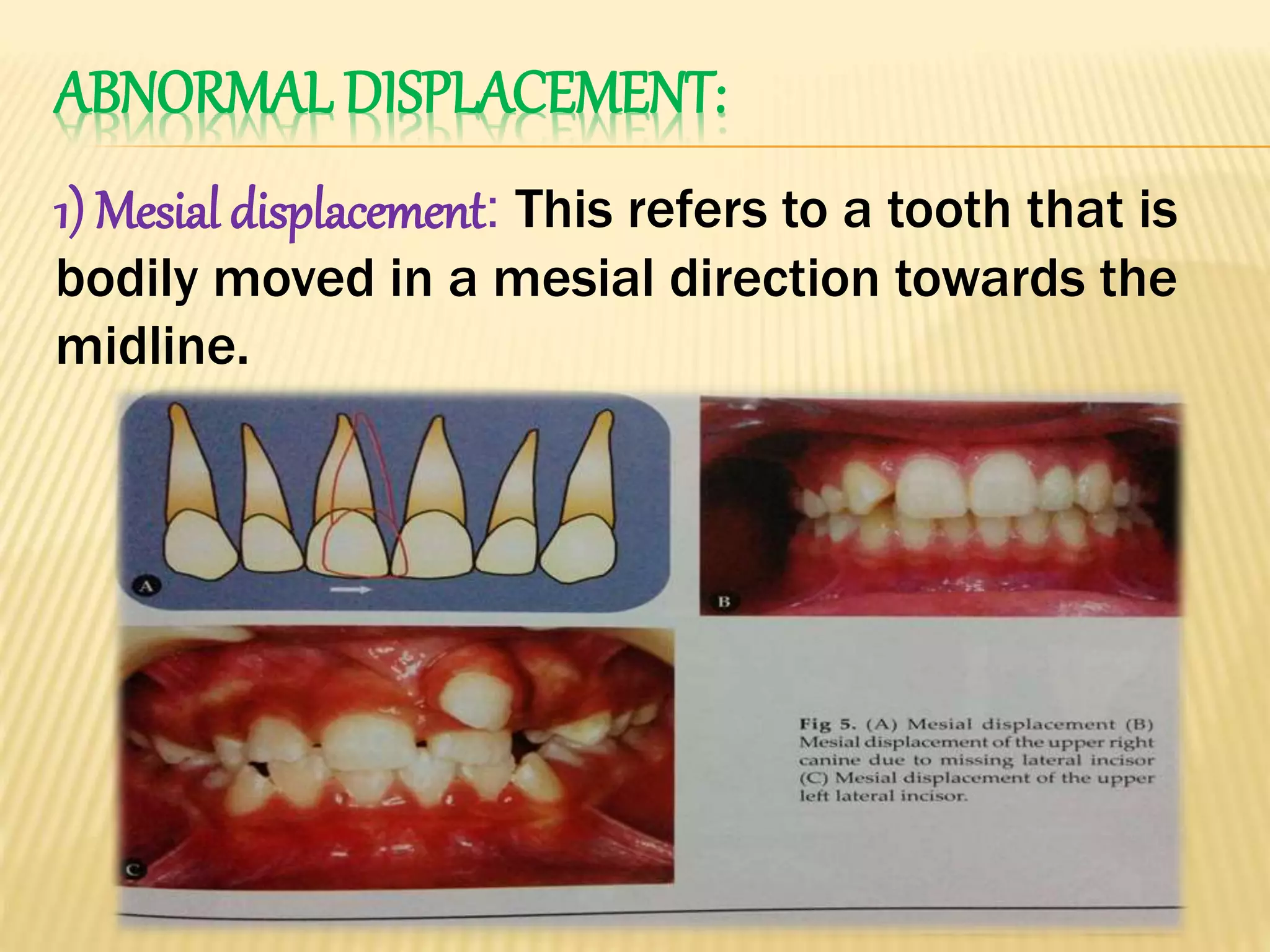 Classification of malocclusion | PPTX