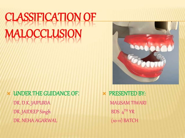 Classification of malocclusion | PPTX
