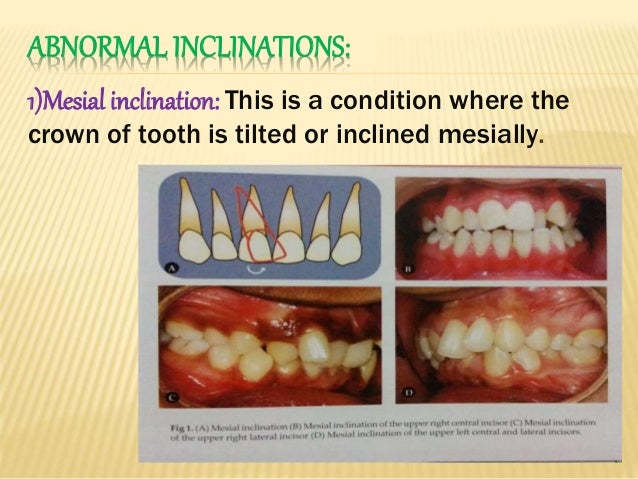 Classification of malocclusion