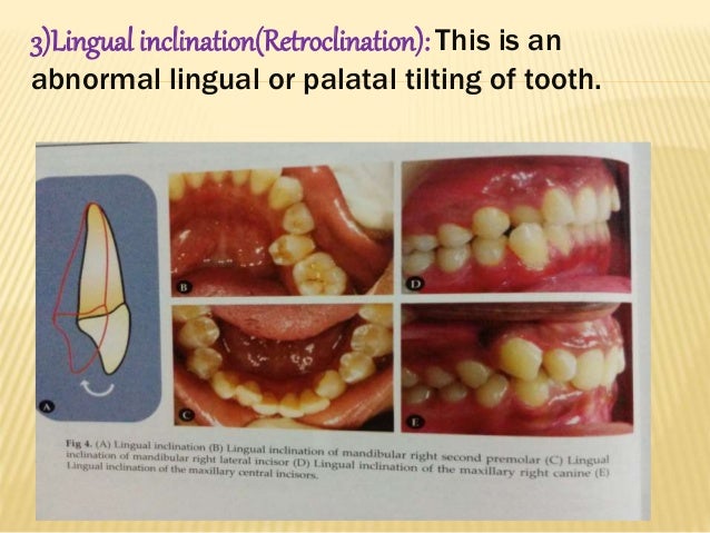 Classification of malocclusion