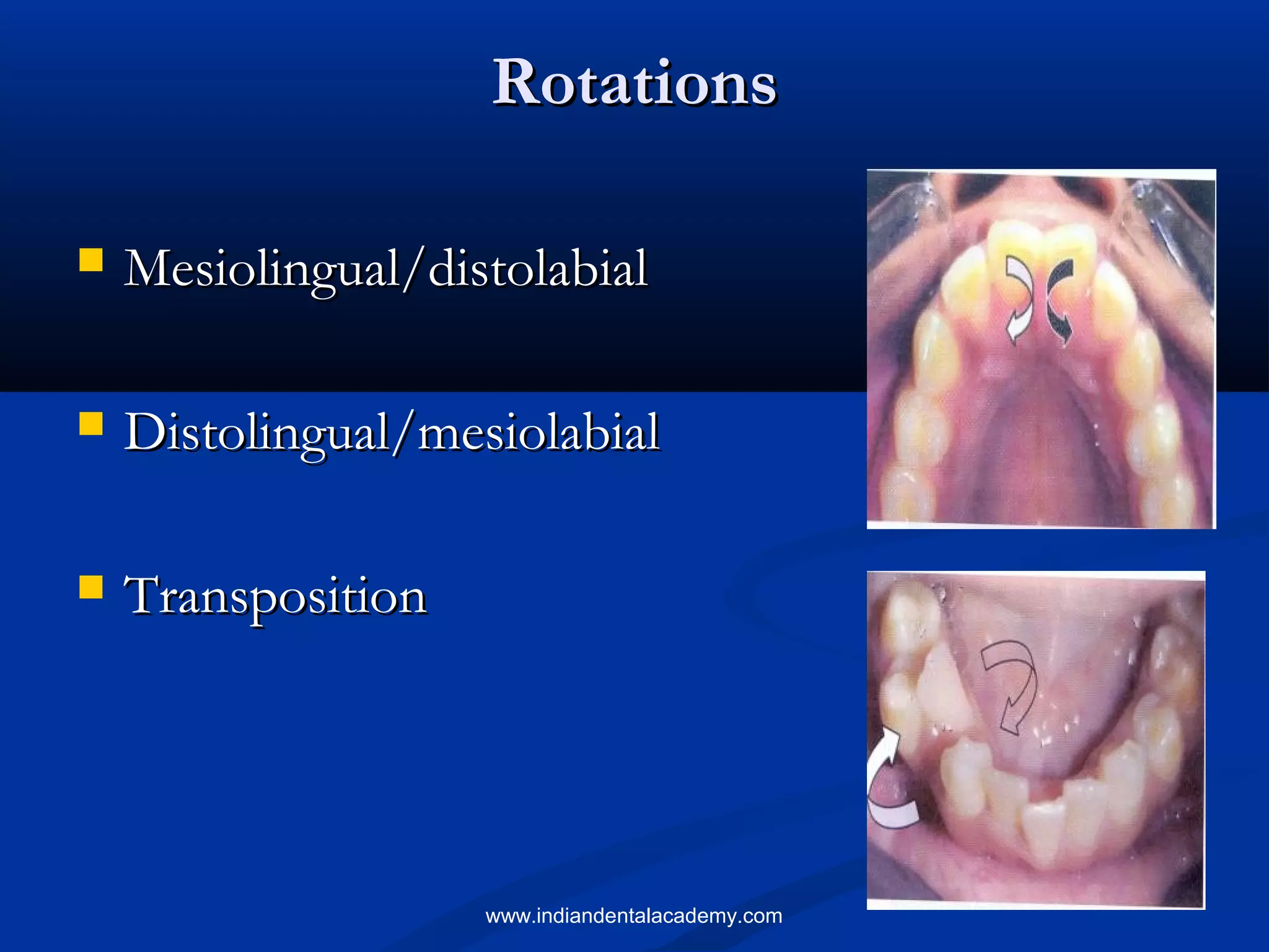 Classification of malocclusion | PPT