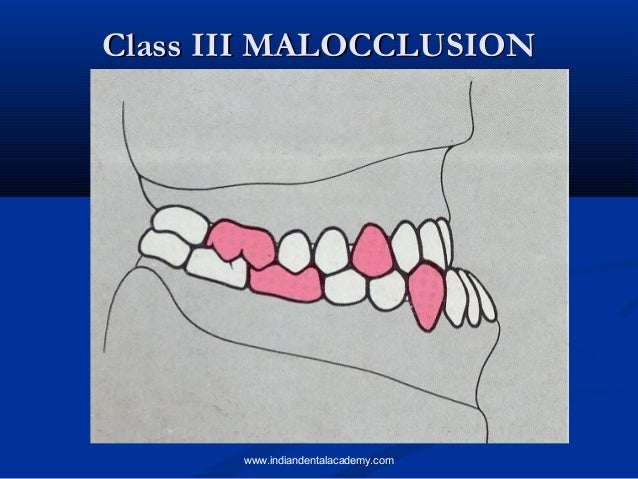 Classification of malocclusion