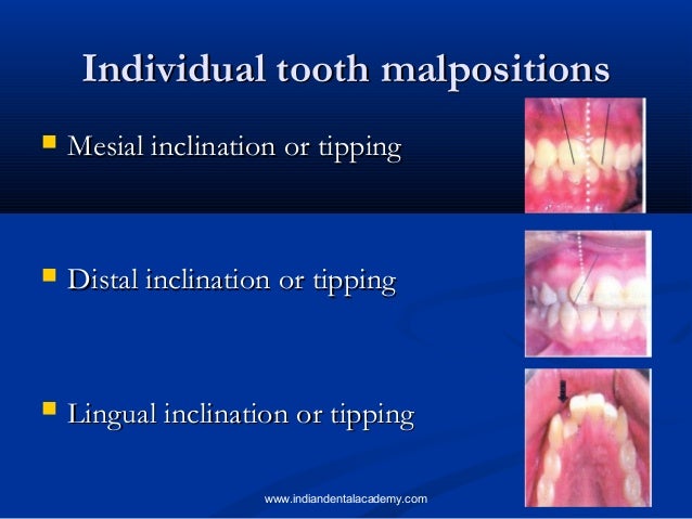 Classification of malocclusion