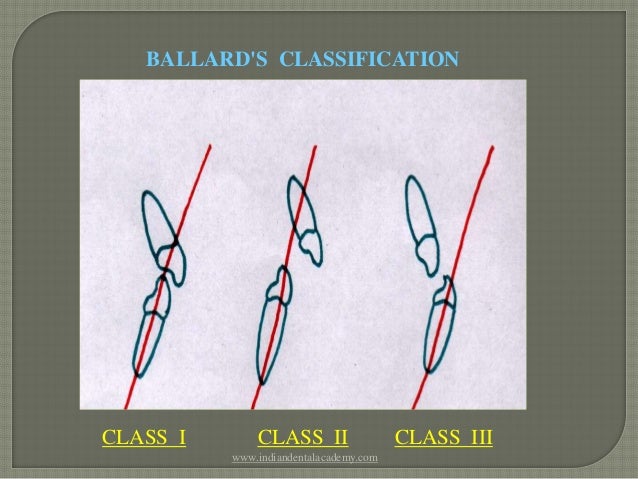 Classification of malocclusion