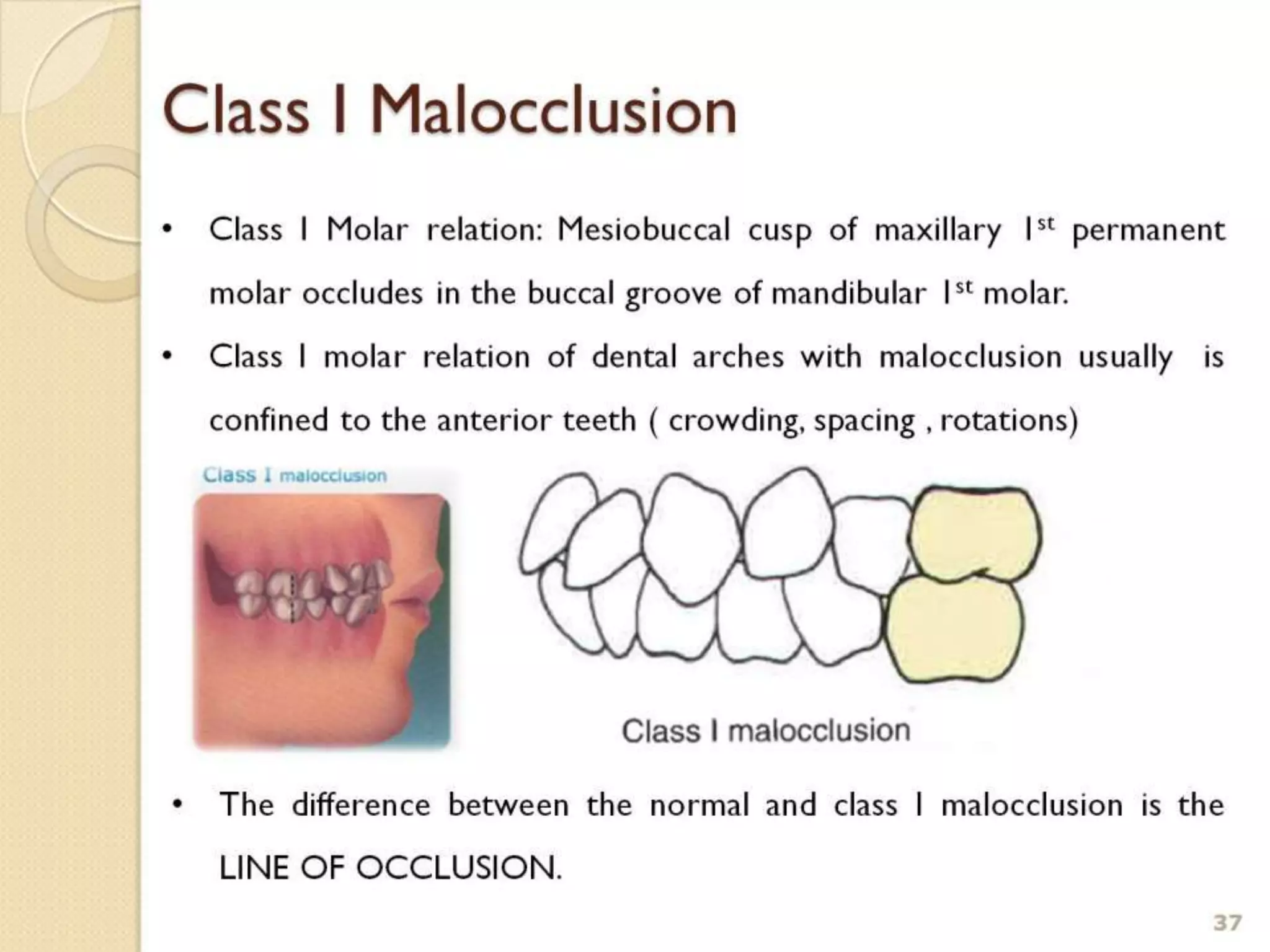 Classification of malocclusion | PPT