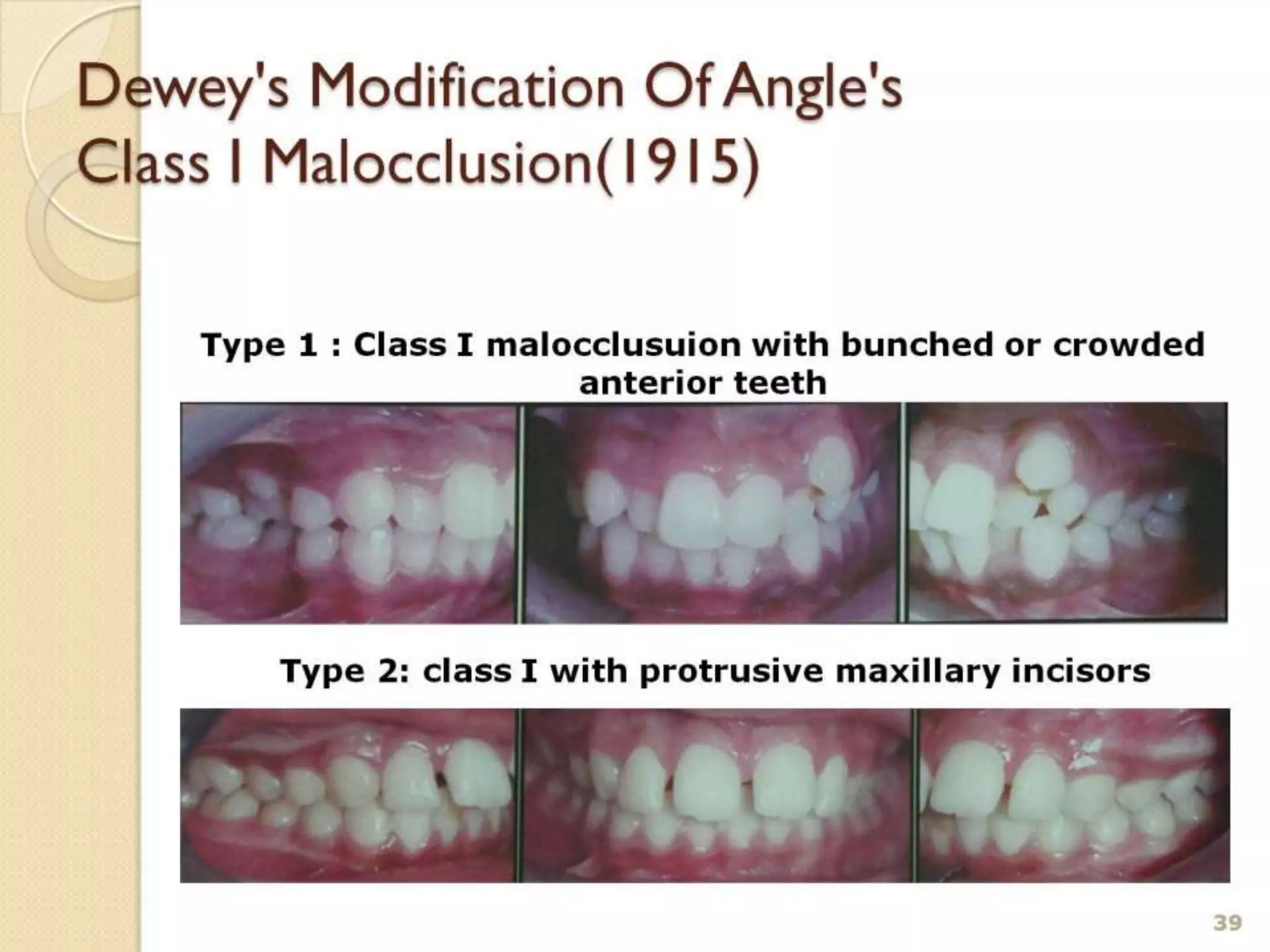Classification of malocclusion | PPTX