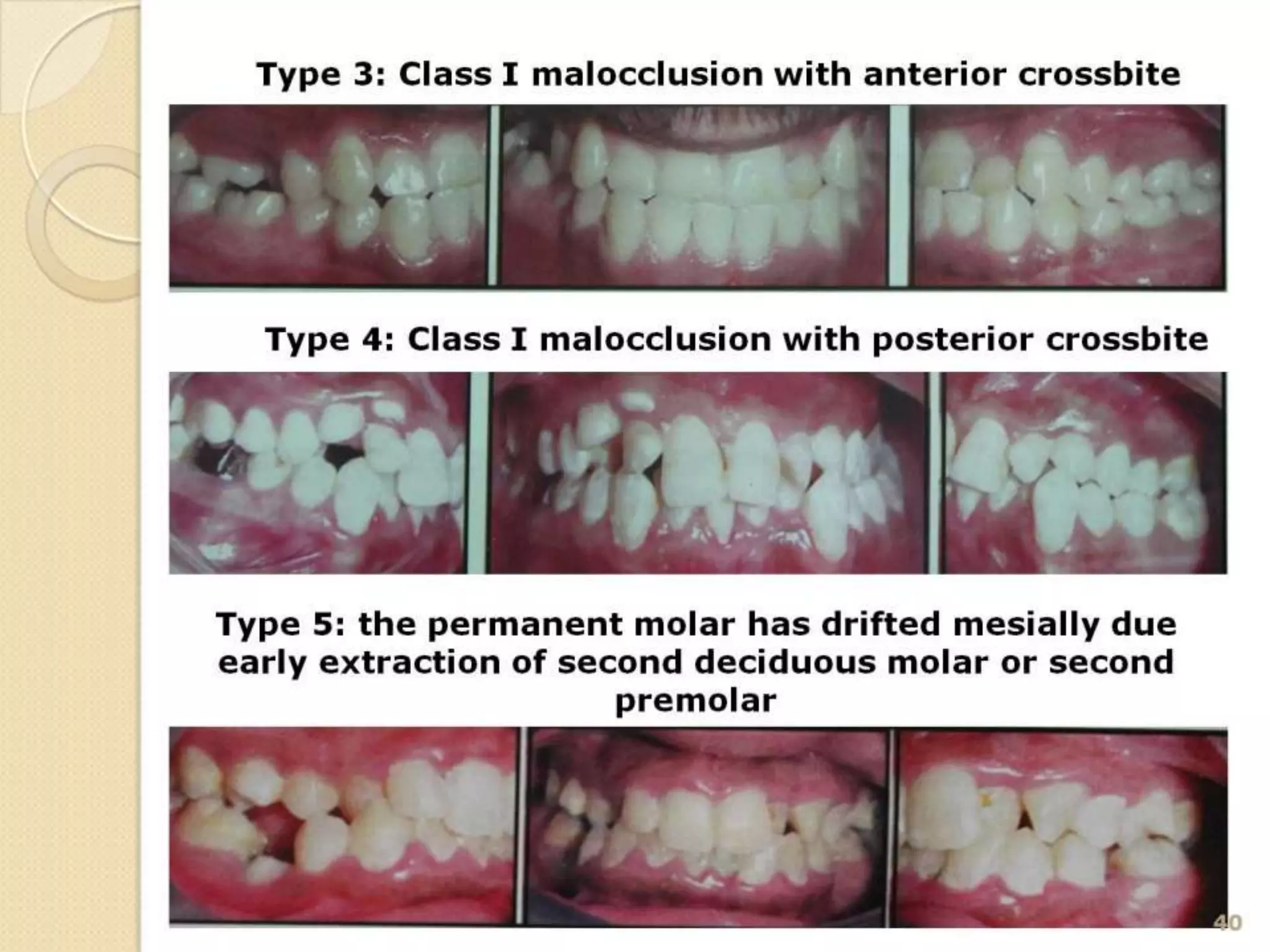 Classification of malocclusion | PPT